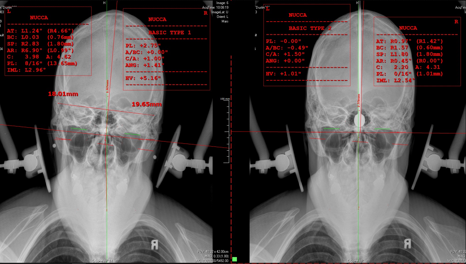 What is NUCCA? - Koru Chiropractic